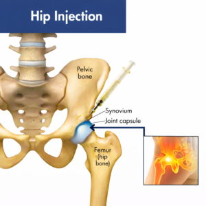 Types of Injections for Hip Pain: Relief & Treatment Guide